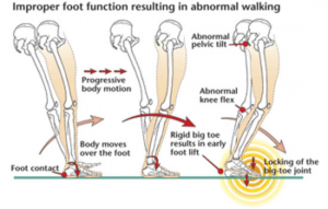 How important is your big toe??? – Optimal Biomechanics